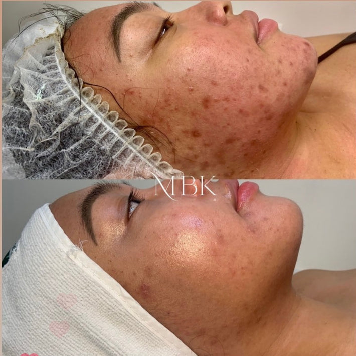 DMK Enzyme Therapy | MBK Med Spa